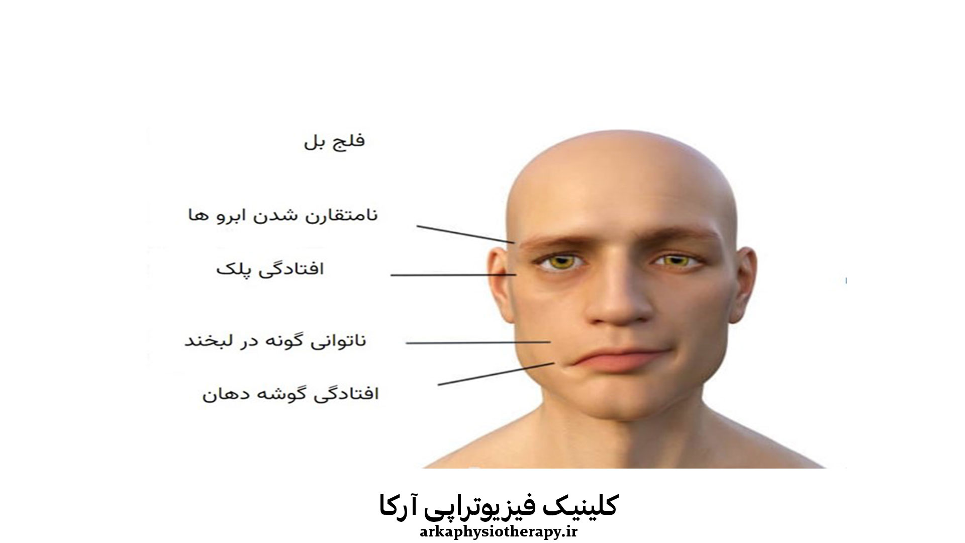 فلج بلز چیست؟ - فیزیوتراپی آرکا