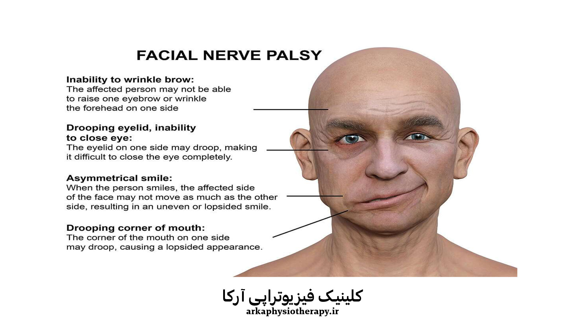 درمان فلج بلز با فیزیوتراپی - فیزیوتراپی آرکا